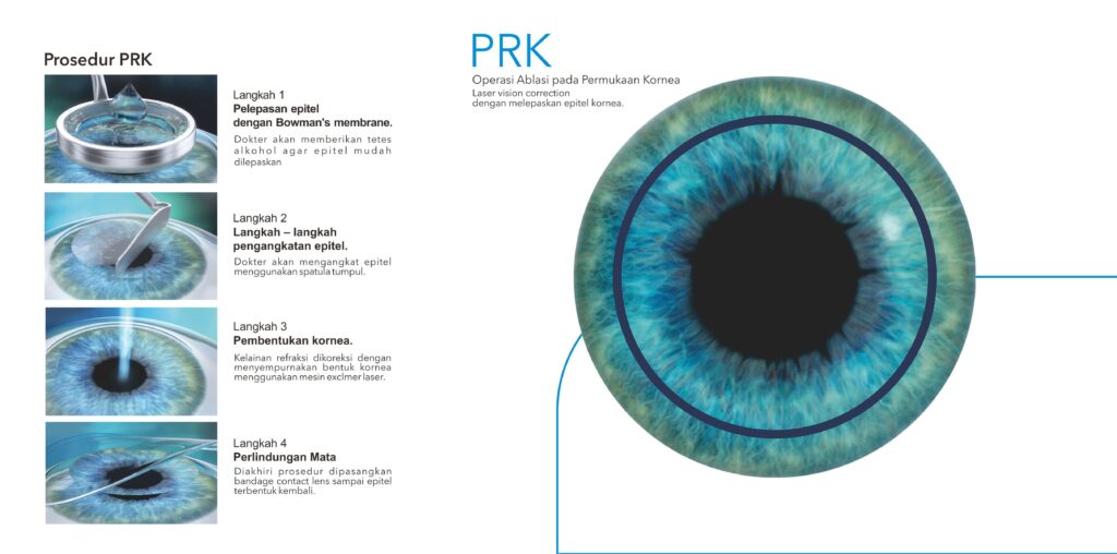 Wajib Tahu! Inilah 3 Jenis Teknik Operasi Lasik - Klinik Mata KMU