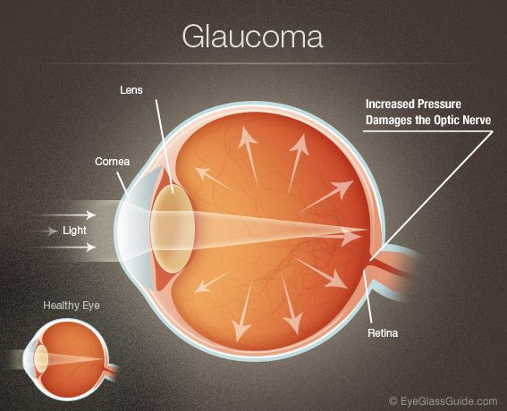 Glaukoma Sudut Tertutup : Gejala, Penyebab, & Pengobatan