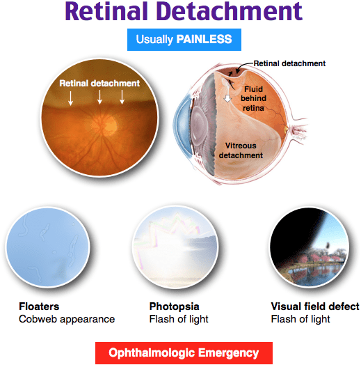 Penyakit Retina: Jenis,Diagnosa,Pengobatan,Pencegahannya