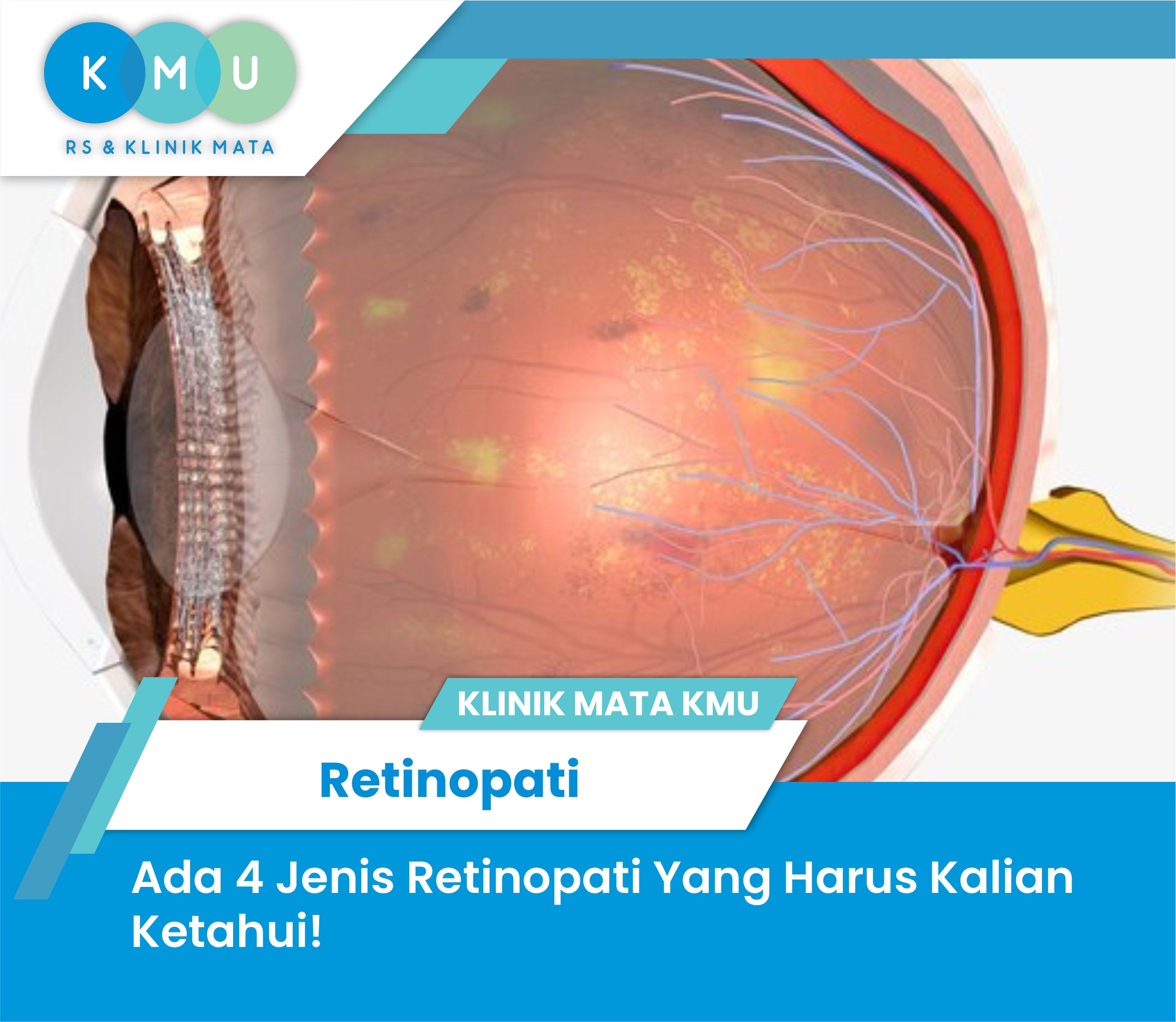 4 Jenis Retinopati Beserta Gejala dan Cara Mengobatinya