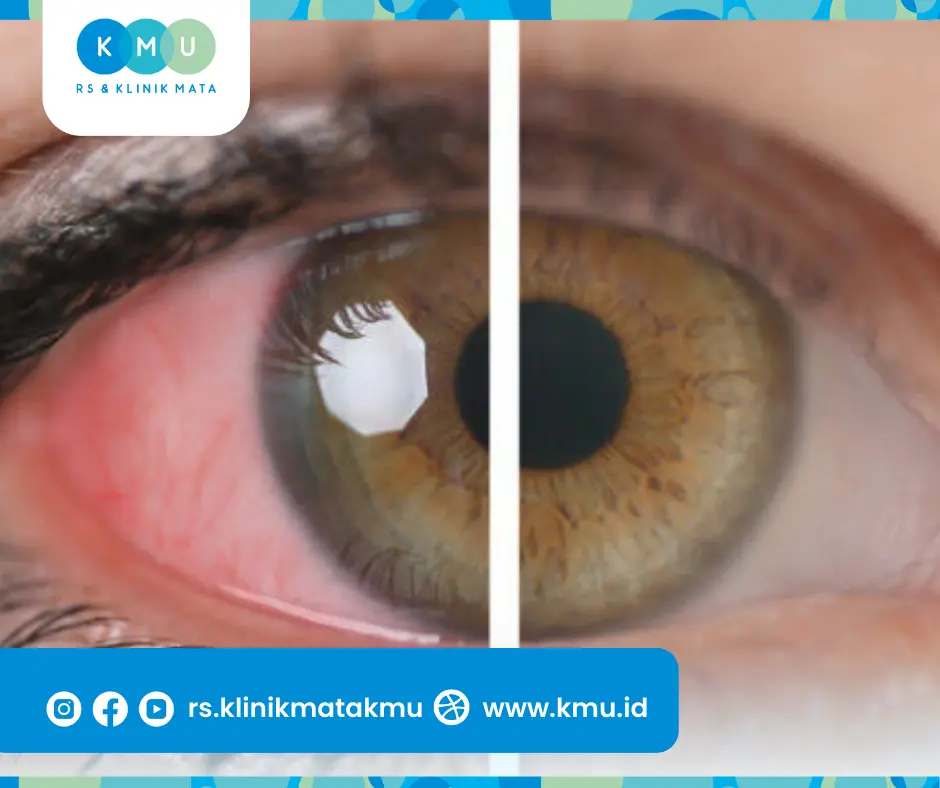 Iritis Mata : Peradangan Iris Mata yang Perlu Diwaspadai - RS & Klinik ...