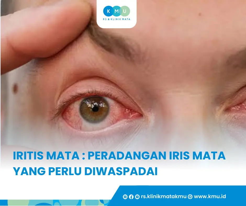Iritis Mata : Peradangan Iris Mata yang Perlu Diwaspadai - RS & Klinik ...