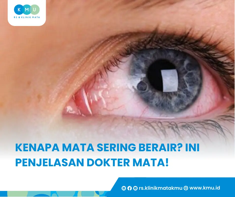 Kenapa Mata Sering Berair? Ini Penjelasan Dokter Mata!